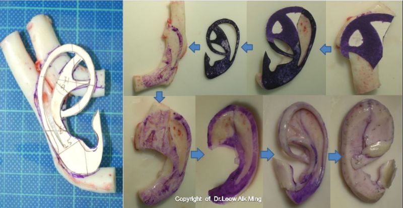 Ear Reconstruction - Elegant Plastic Surgical Centre in Ipoh & Manjung ...