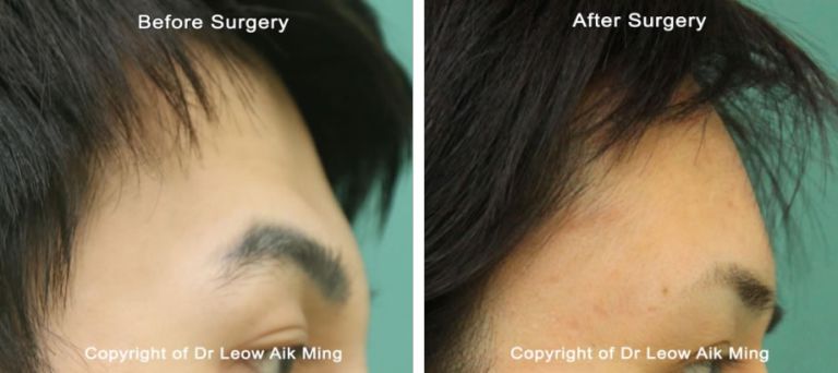 Forehead Contouring Surgery - Elegant Plastic Surgical Centre in Ipoh ...